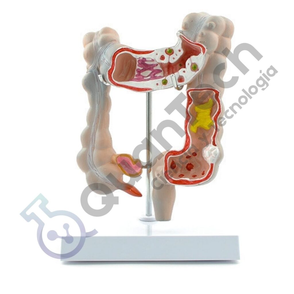 MODELO ANATOMICO DE COLON HUMANO CON CUADROS CLINICOS – Quantech