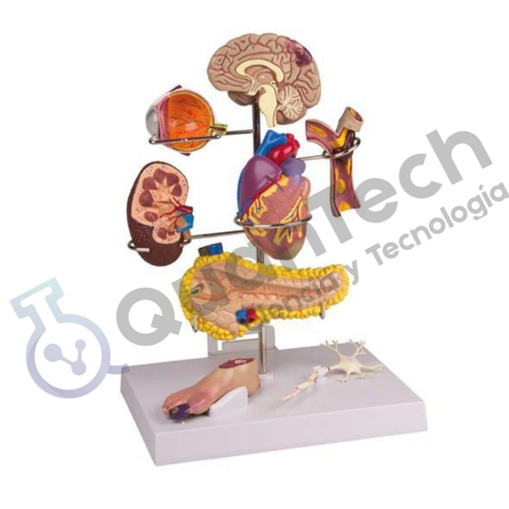 MODELO ANATOMICO COMPLICACION DE LA DIABETES – Quantech