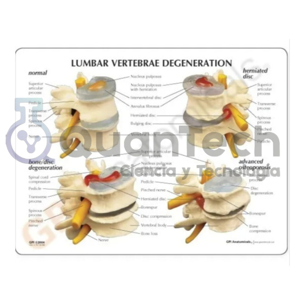 VÉRTEBRAS LUMBARES PATOLOGIA DEGENERATIVA – Quantech